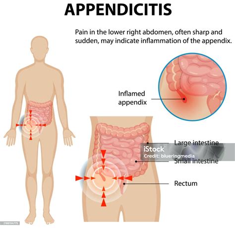 Illustration Of Appendicitis Symptoms And Affected Organs Stock