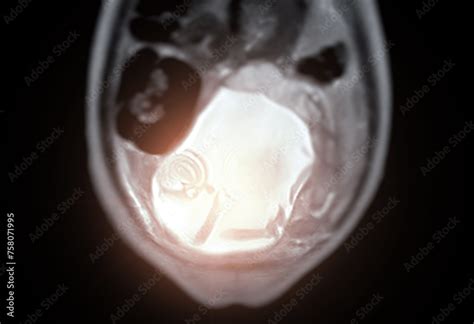 Mri During Pregnancy Ensures Non Invasive Evaluation Of Fetal Health