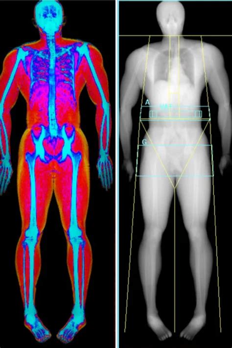 DEXA Scan Nebraska Weight Wellness