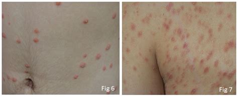 Papular Psoriasis