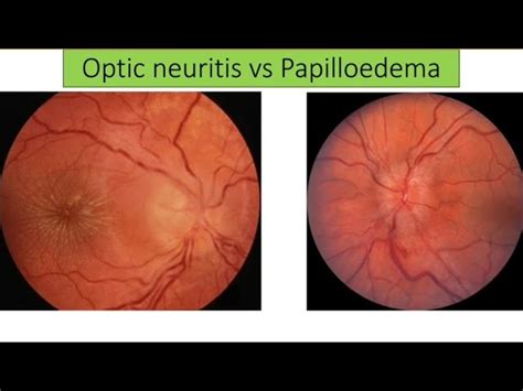 Normal Optic Nerve Vs Papilledema