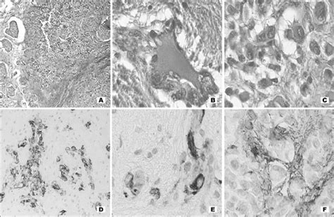 A Tumor Histopathological Findings Showed Epithelial Cells That