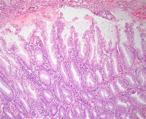 Hyperplastic Polyp Pathology Outlines Clinical Pathology Intestinal