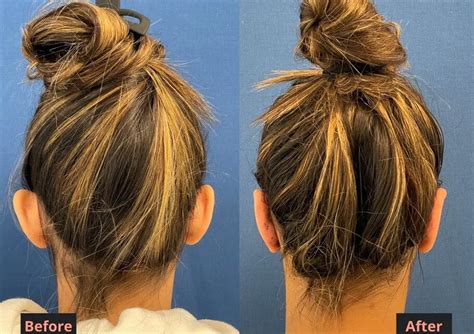 ניתוח הקטנת חזה לגבר גניקומסטיה דר רותם צור קומפרלי