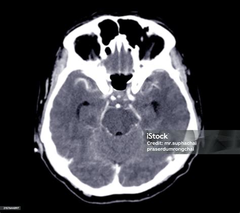 A Ct Brain Scan Reveals A Subarachnoid Hemorrhage With Clear Signs Of
