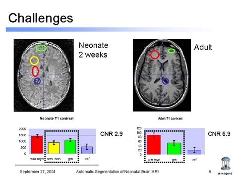 Automatic Segmentation Of Neonatal Brain Mri Marcel Prastawa