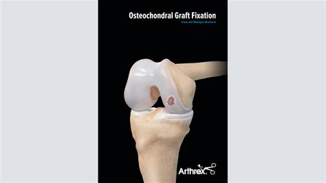 Arthrex Ocd Fixation