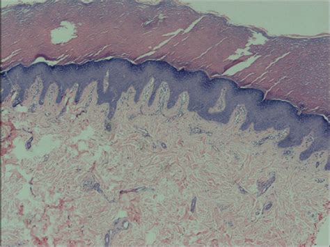 Hereditary Papulotranslucent Acrokeratoderma A Simultaneous Presentation In Daughter And Mother