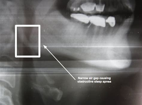 Sleep Apnea Surgery Dr Hamilton