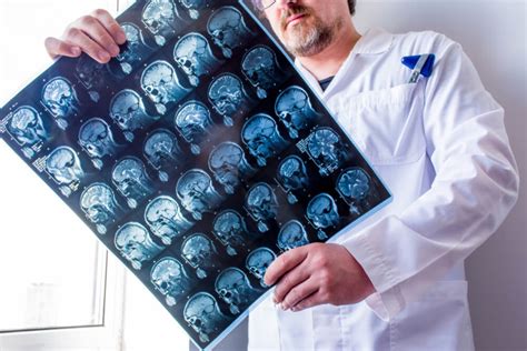 Tratamento De Epilepsia Com Cannabis Como Funciona E Vantagens
