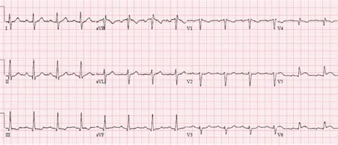 Posterior Mi Ecg Cases 6 Emergency Medicine Cases