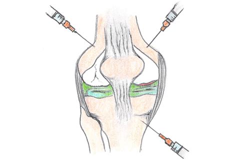 Nerve Block Serenity Surgical