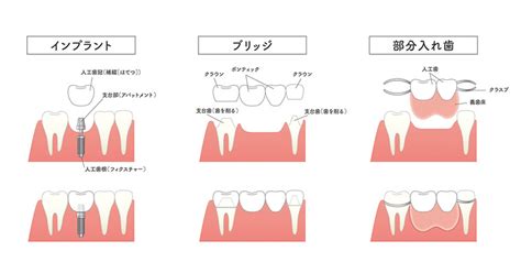 むし歯の治療 おおやデンタルクリニック