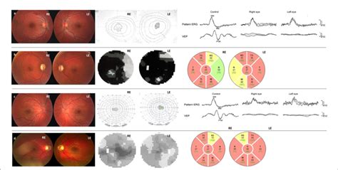 A Case E Fundi At The Disease Onset Hyperemic Optic Disks Without
