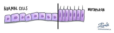 Metaplasia Mypathologyreportca