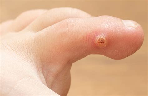 What Causes Plantar Warts On Fingers