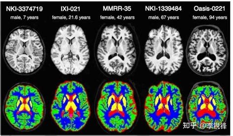 Mindspore应用案例：ai生物医疗影像领域，用3d Unet解决luna16数据集下肺叶分割任务 知乎