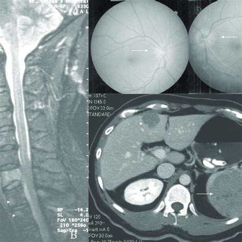A And B Excision Biopsy Of Lymph Node Showing Effacement By Download Scientific Diagram