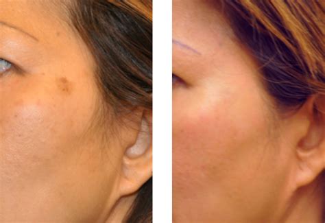 Seeing Spots Before Your Eyes After Surgery Qerywise