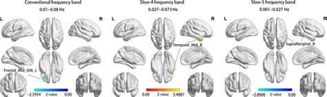 Altered Functional Connectivity Fc Results Of The Right Amygdala In Download Scientific