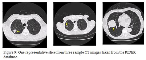 Automatic Pulmonary Nodule Growth Measurement Through Ct Image Analysis Based On Morphology
