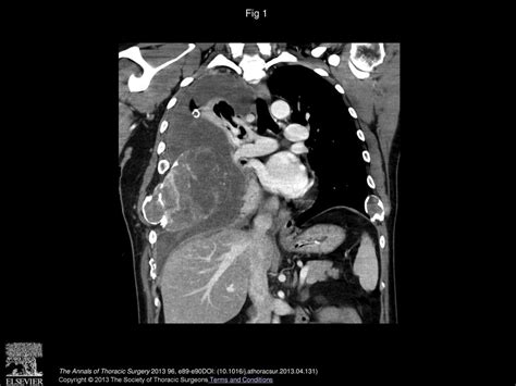 Sarcomatous Degeneration In Fibrous Dysplasia Of The Rib Cage Ppt