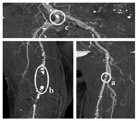 Different Arterial Diseases Stenosis A Occlusion Caused By