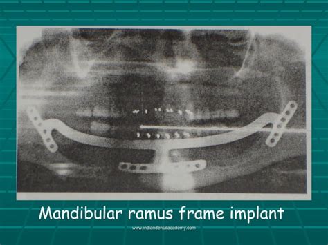 Evolution Classification And Components Of Implants4 Ppt