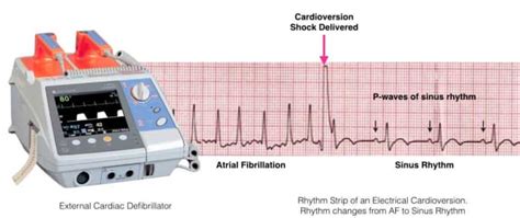 Atrial Fibrillation My Father Is Always Out Of Rhythm Patients Lounge