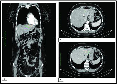 Abdominal Ct Scan A Early Arterial Phase In Contrast Enhanced Ct