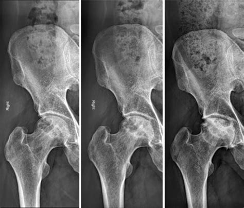 Hip Avn Osteonecrosis Sam Martin
