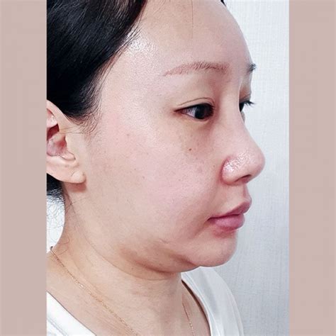 코 재수술 자가 늑연골 귀연골 두피근막 이중턱 흡입 및 근육 묶기 リアルレビュー 21성형외과 Jp