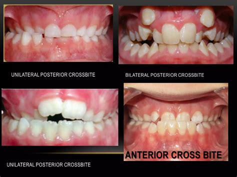 Malocclusion Pptx