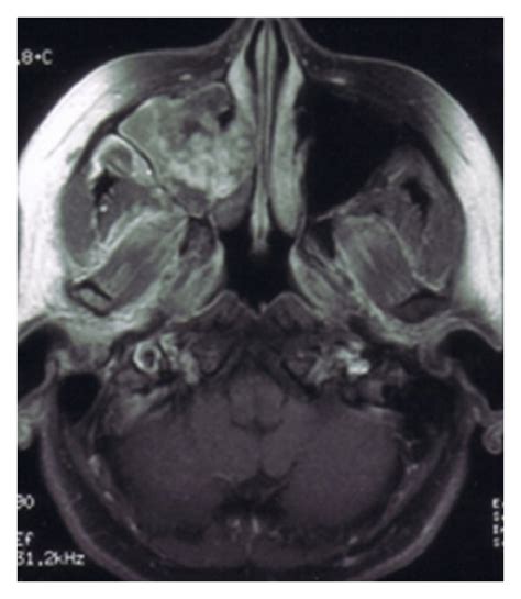 A 36 Year Old Female Had A 2 Month History Of Recurrent Epistaxis A