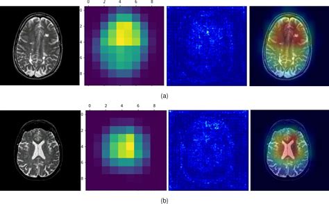 Detection And Classification Of Multiple Sclerosis From Brain MRIs By Using MobileNet D CNN