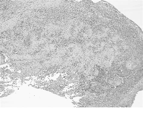 Figure 1 From Temporal Bone Histopathology Case Of The Month Sarcoidosis Of The Middle Ear And