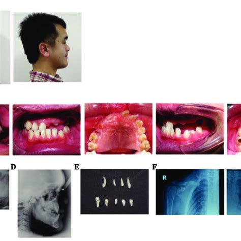 Mutation Analysis Of The Runx2 Gene In A 23 Year Old Patient With