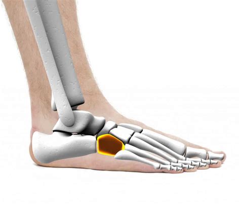 Cuboid Syndrome Diagnosis And How To Treat Cuboid Syndrome