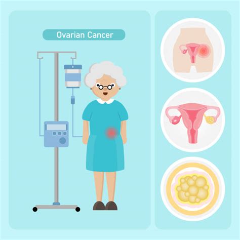 Ovarian Cyst Illustrations Royalty Free Vector Graphics And Clip Art