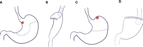 Scope Of Gastrectomy And Reconstruction Of Digestive Tract A