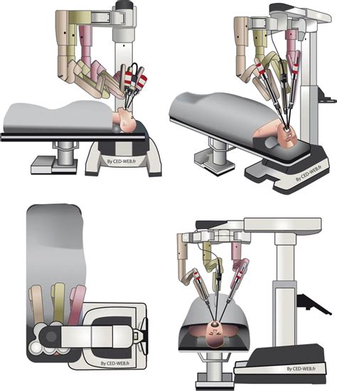 Patient Side Cart And Robotic Arm Positioning For Transoral Robotic