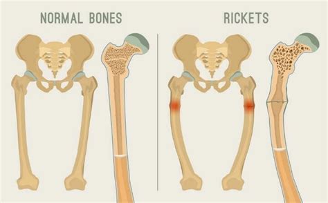 Difference Between Osteoporosis And Osteomalacia Respectcaregivers