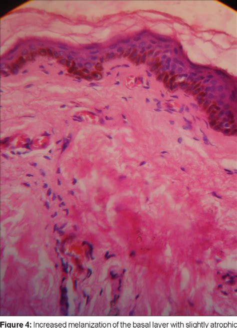 Figure 1 From Acral Freckling With Palmar Pits Semantic Scholar