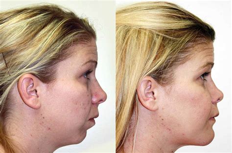 Counterclockwise Face Rotation Corrective Jaw Surgery Dr Antipov