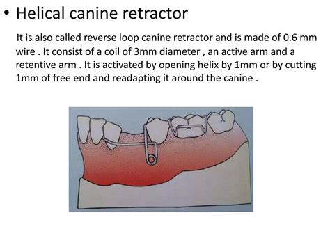 Removable Orthodontic Appliance Pptx Dental Health Diseases And