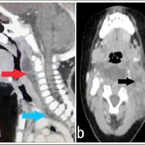 Ct Scan Of The Neck With Contrast A Multi Loculated Large