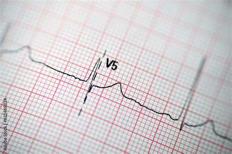 Ecg Electrocardiograph Paper That Shows Sinus Rhythm Abnormality Of