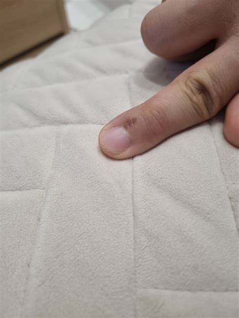 손톱 위에 피부가 색이 검게 변했어요 지식in