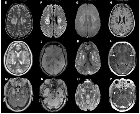 Cómo el coronavirus ataca el cerebro En Segundos Panama