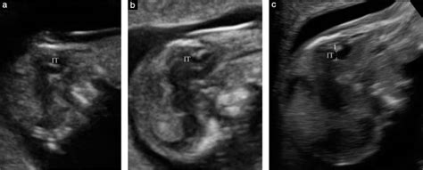 Visualization Of The Intracranial Translucency It In Three Fetuses In Download Scientific